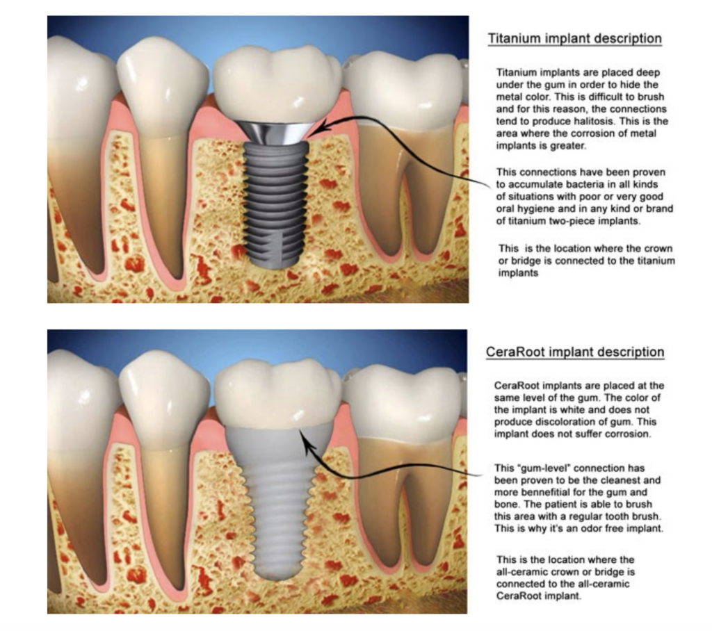 Mastering the Choice: Titanium vs Ceramic Dental Implants